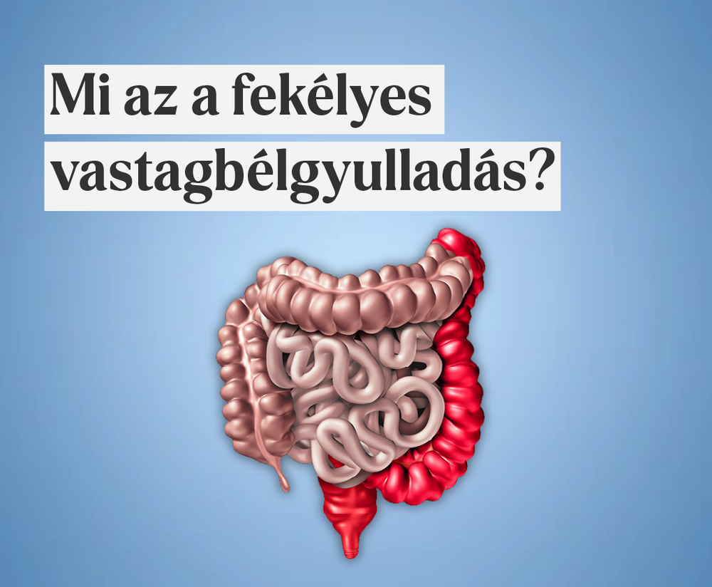 Fekélyes vastagbélgyulladás, avagy Colitis ulcerosa